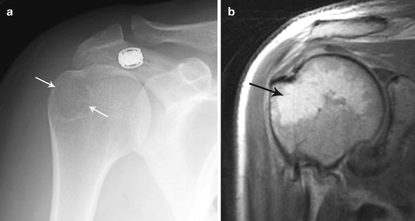 Bone Tumor Mimickers | SpringerLink