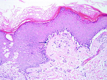 Intraepidermal Blisters | SpringerLink