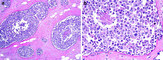 Risk Lesions of the Breast: Usual Ductal Hyperplasia, Atypical Ductal ...