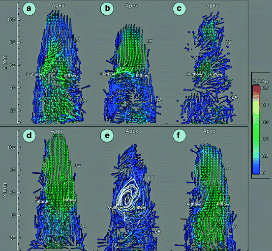 Vortex Formation in the Heart | SpringerLink