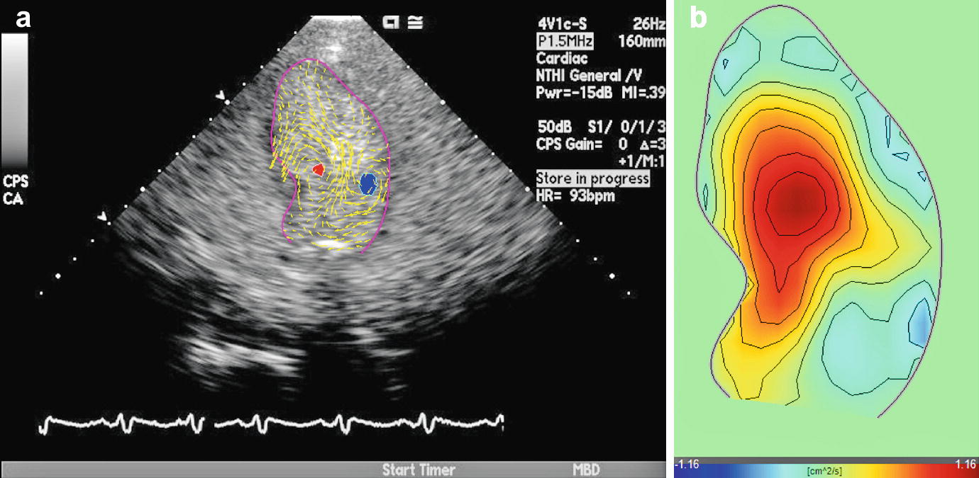 Vortex Formation in the Heart | SpringerLink