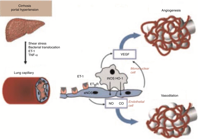 Hepatopulmonary Syndrome | SpringerLink