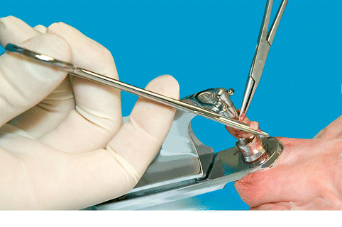 Newborn Circumcision Techniques | SpringerLink