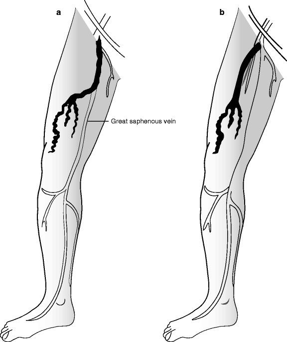 Tributary Treatment Strategies: Treatment of Varicose Veins | SpringerLink