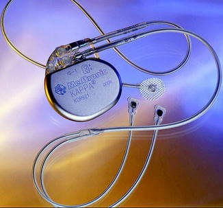 Epicardial/Epimyocardial Pacing | SpringerLink