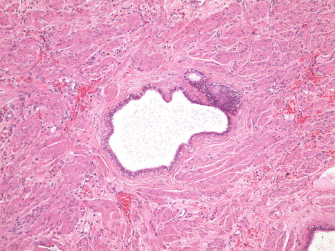 Pathology of the Fallopian Tube | SpringerLink