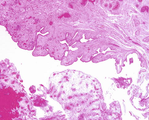 Pathology of the Fallopian Tube | SpringerLink