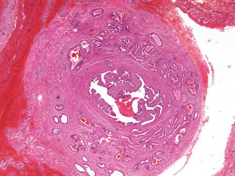 Pathology of the Fallopian Tube | SpringerLink
