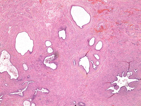 Pathology of the Fallopian Tube | SpringerLink