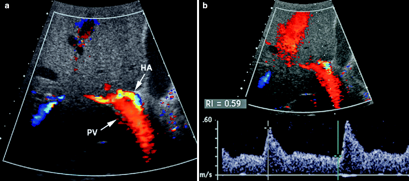 Ultrasound of the Hepatoportal Circulation | SpringerLink