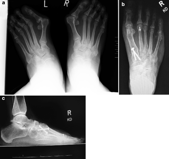 The Lapidus Procedure | SpringerLink