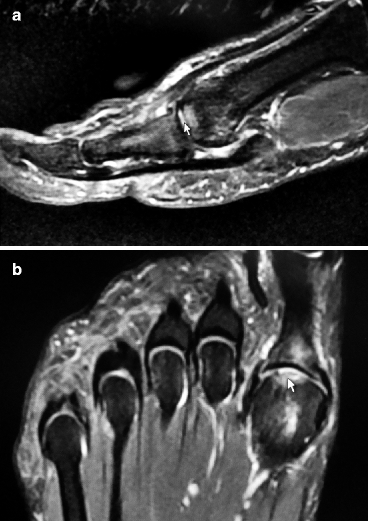 Turf Toe Injuries | SpringerLink