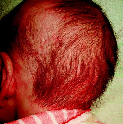 Acrodermatitis Enteropathica Like Eruption | SpringerLink