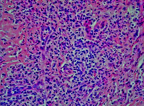 Acral Necrosis in a Heavy Smoker | SpringerLink