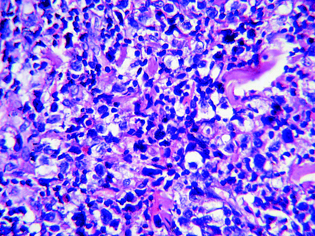 Pyoderma Gangrenosum-Like Lesions | SpringerLink