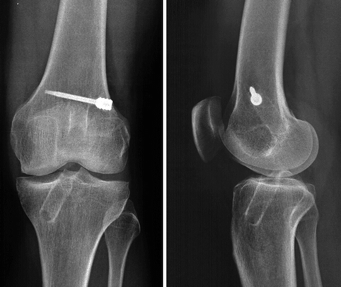 The Need for an Objective Measurement In Vivo of Rotational Stability ...
