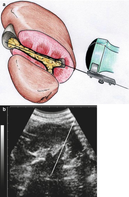 Tips to Puncture the Kidney Using Ultrasound | SpringerLink