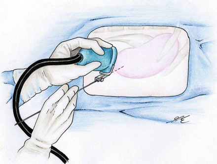 Tips to Puncture the Kidney Using Ultrasound | SpringerLink