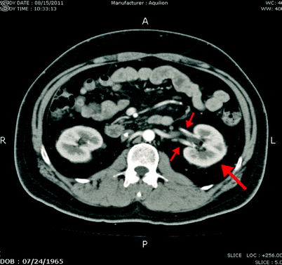 Percutaneous Nephrostomy, Antegrade Stent Placement, and Radiological ...