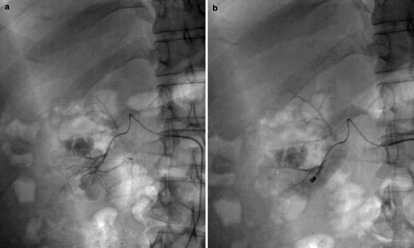 Percutaneous Nephrostomy, Antegrade Stent Placement, and Radiological ...