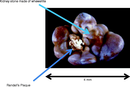 Application of Physical Methods to Kidney Stones and Randall’s Plaque ...