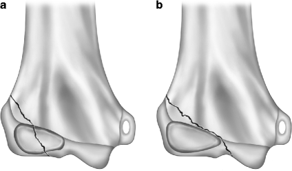 Fractures in Children | SpringerLink