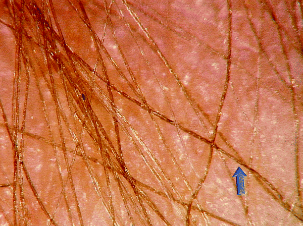 Pili Torti | SpringerLink