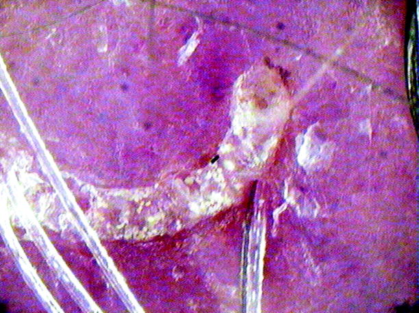 Parasitic Scalp Infections | SpringerLink