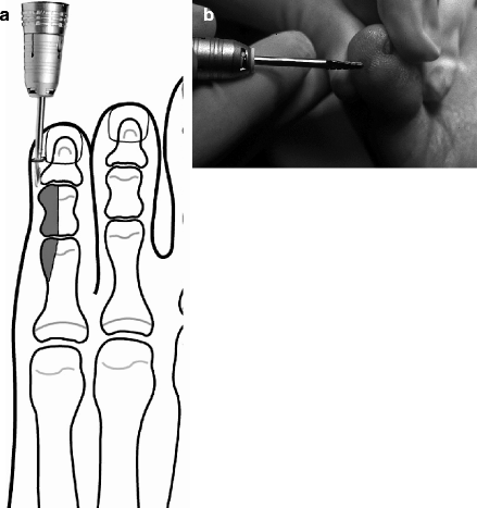 Minimally Invasive Management of Dorsiflexion Contracture at the ...