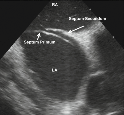 A Comparison of Methods to Detect and Quantitate PFO: TCD, TTE, ICE and ...