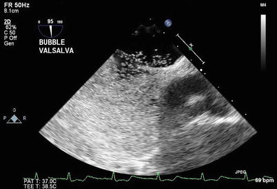 A Comparison of Methods to Detect and Quantitate PFO: TCD, TTE, ICE and TEE | SpringerLink