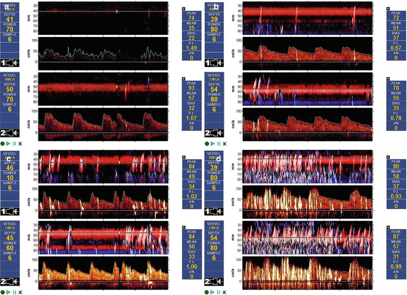 A Comparison of Methods to Detect and Quantitate PFO: TCD, TTE, ICE and ...