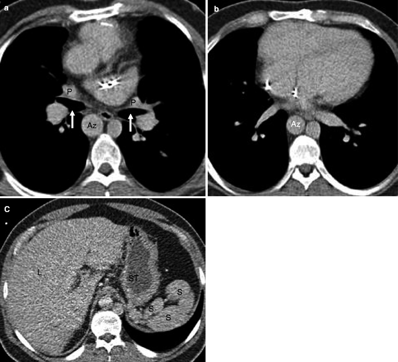 Heterotaxy Syndrome | SpringerLink