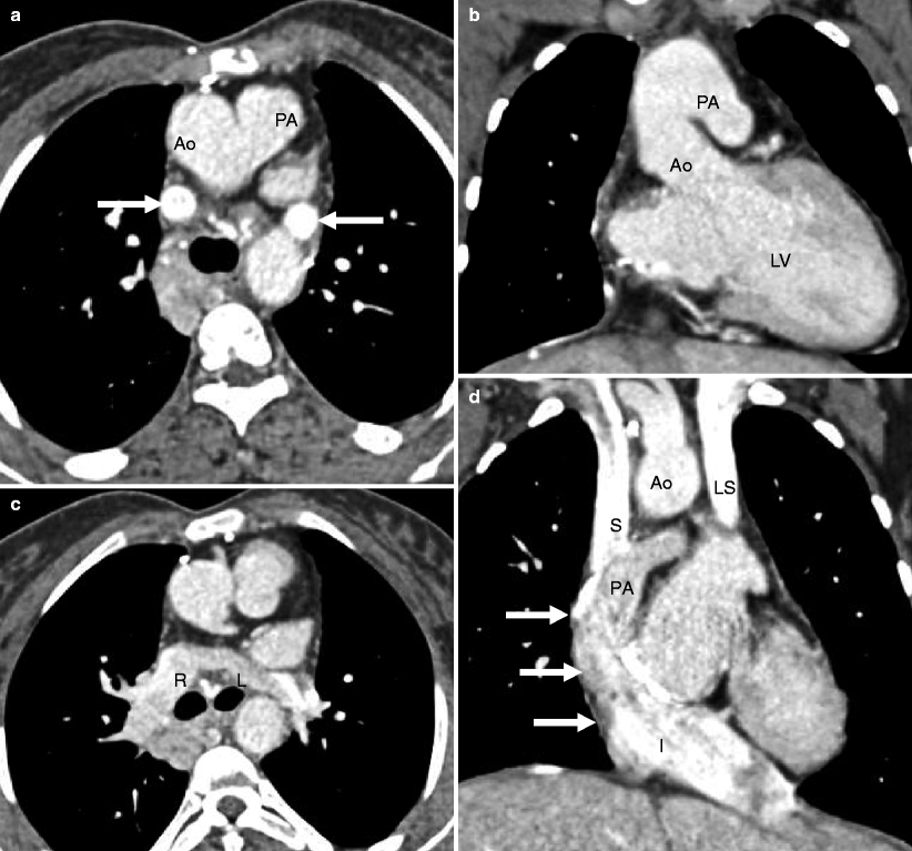 Damus–Kaye–Stansel Procedure | SpringerLink