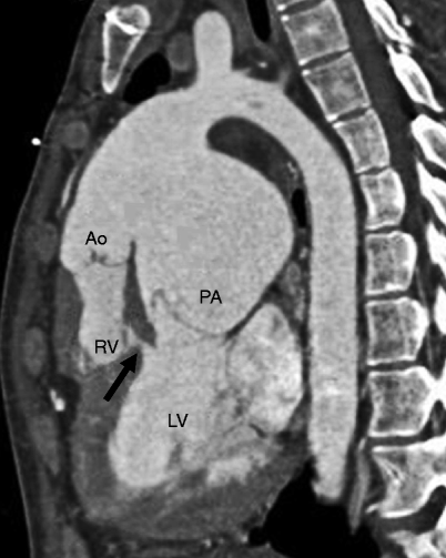 Damus–Kaye–Stansel Procedure | SpringerLink