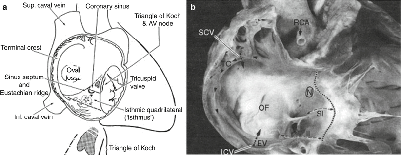 Importance of Isthmus Structure in the Right Atrium | SpringerLink