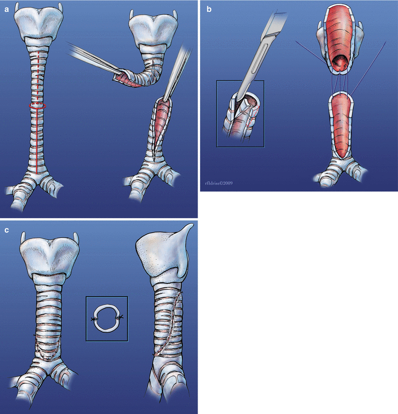 Vascular Rings, Tracheoplasty, and Pulmonary Artery Sling | SpringerLink