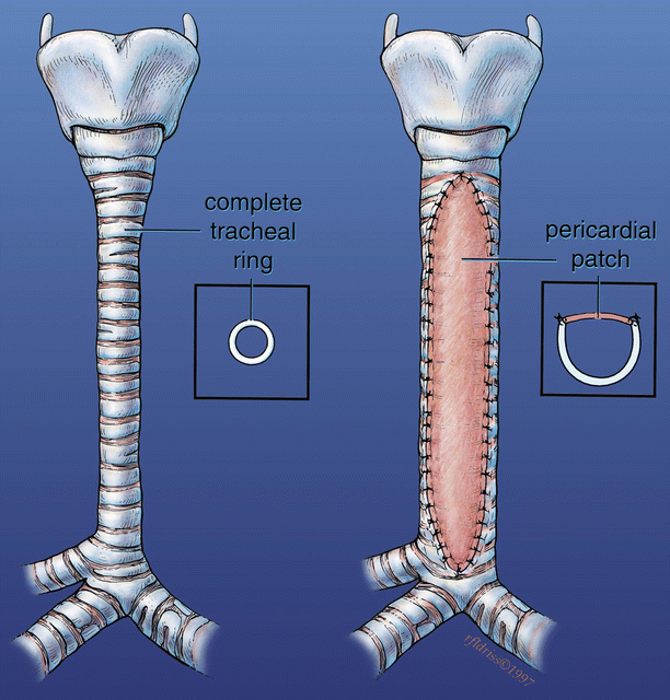Vascular Rings, Tracheoplasty, and Pulmonary Artery Sling | SpringerLink
