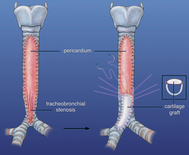 Vascular Rings, Tracheoplasty, and Pulmonary Artery Sling | SpringerLink
