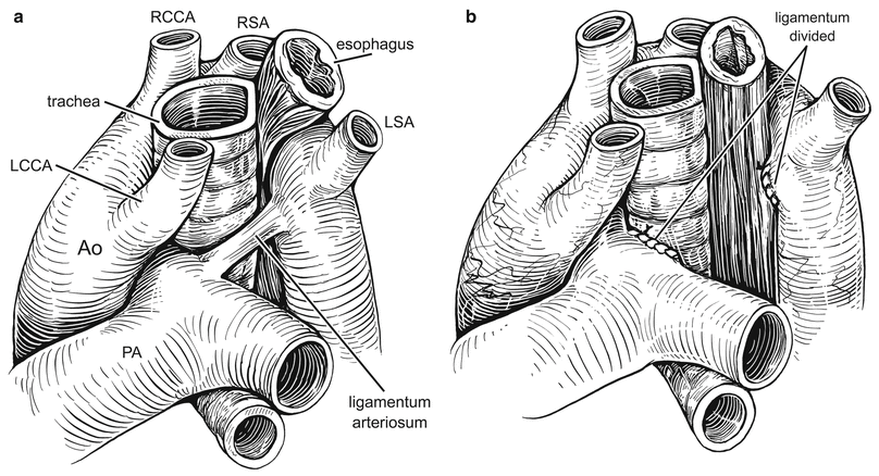 Vascular Rings, Tracheoplasty, and Pulmonary Artery Sling | SpringerLink