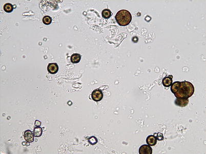 Renal Stone Disease | SpringerLink