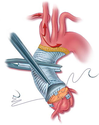 Aortic Valve Resuspension and Graft Replacement of the Ascending Aorta ...