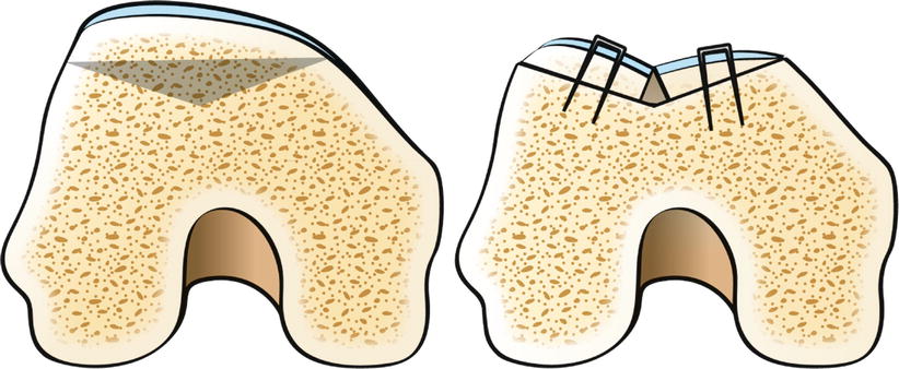 Deepening Femoral Trochleoplasty | SpringerLink