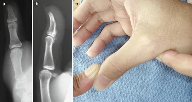 Acute Thumb and Finger Instability | SpringerLink