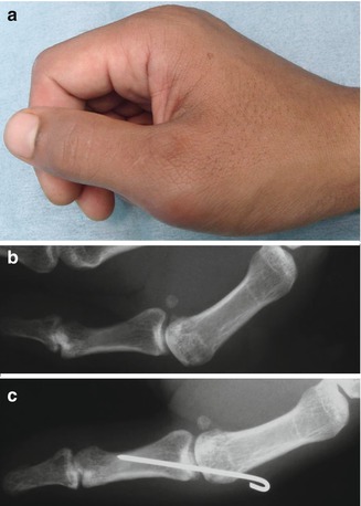 Acute Thumb and Finger Instability | SpringerLink