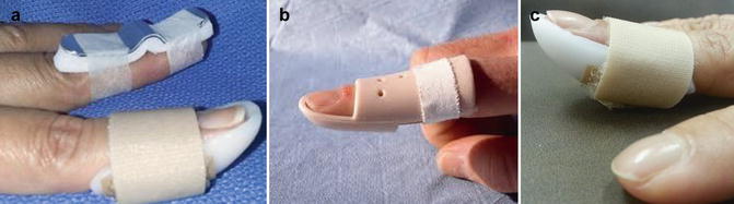 Acute Thumb and Finger Instability | SpringerLink