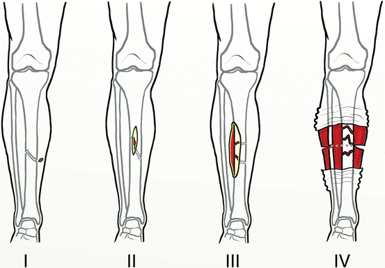 Soft Tissue Injuries | SpringerLink
