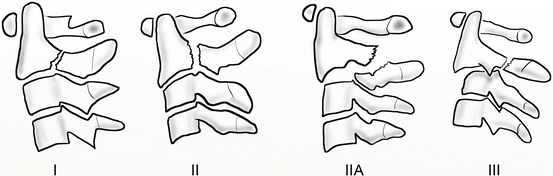 Traumatic Spondylolisthesis of the Axis (Hangman’s Fracture) | SpringerLink