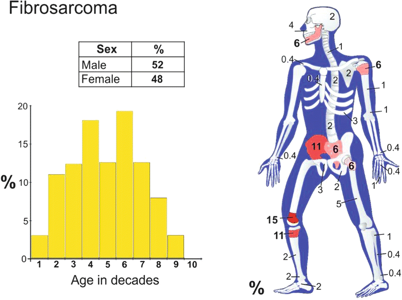 Fibrosarcoma of Bone | SpringerLink