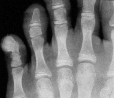 Subungual Exostosis | SpringerLink